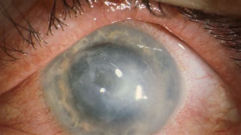 Acanthamoeba Corneal Ulcer