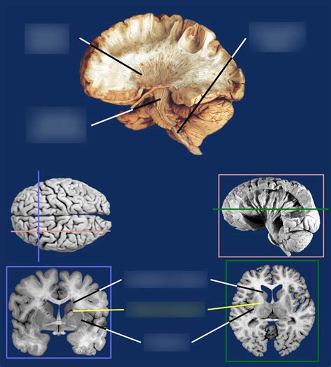 38 03 Pyramidal System Diagram Quizlet