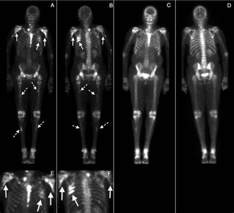 Figure 3 From Voriconazole Induced Periostitis In Two Post Transplant