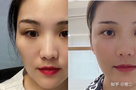 玻尿酸填充效果实测！塑形下巴、太阳穴、额头、法令纹 玻尿酸到底有用吗？ 知乎