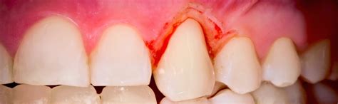 What Is Gingivitis And How To Prevent It