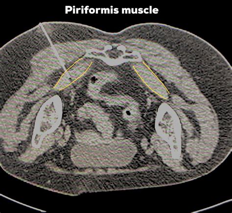 Dr Saemi Ct Guided Piriformis Muscle Injection For Facebook