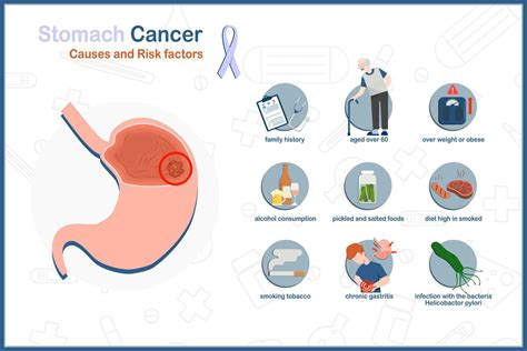Medical Concepts Of Causes And Risk Factors Of Stomach Cancer Obesity Over 60 Years Of Age