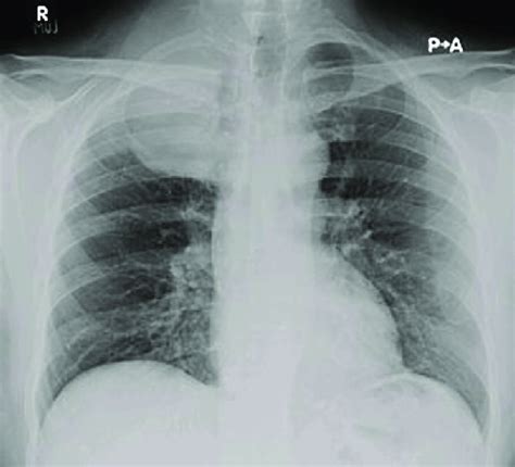 Chest X Ray Showing Right Apical Pulmonary Opacity Download Scientific Diagram