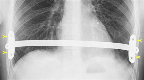 Rit Radiology Nuss Procedure For Pectus Excavatum
