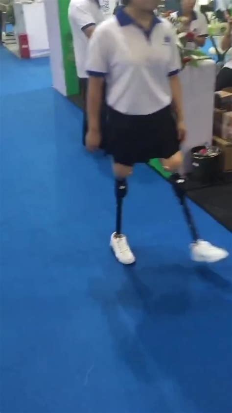 Dak Woman Practice Walking With Prosthetics ThisVid Com