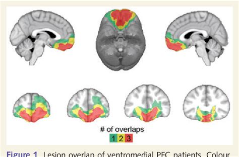Figure 1 From Ventromedial Prefrontal Cortex Mediates Visual Attention During Facial Emotion
