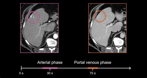 Abdominal Ct Cancer Staging • Litfl • Radiology Library