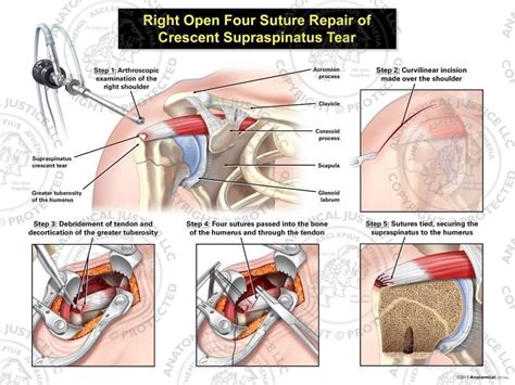 Supraspinatus Tendon Tear Treatment