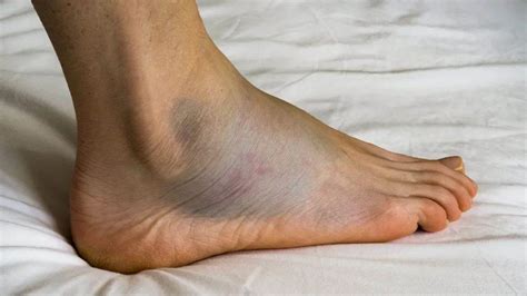 Swelling In Legs इन गंभीर बीमारियों का संकेत देती है पैरों की सूजन