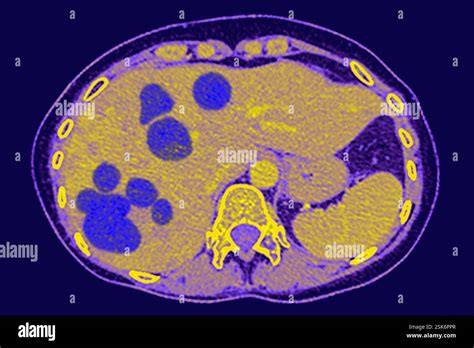 Secondary Liver Cancer Coloured Computed Tomography Ct Scan Of A