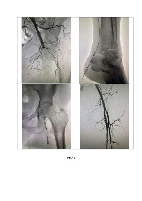 Endovascular Acutelimbischaemia Interventionalradiology Lijesh Kumar
