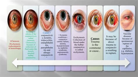 Examination Of Conjunctivaabnormalities Pptx