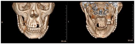 Postoperative Ct 3d Virtual Reconstruction Download Scientific Diagram