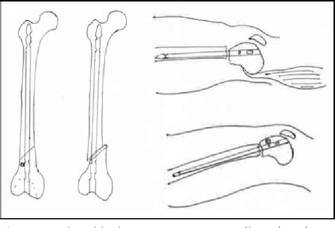 Figure 1 From Blocking Screws An Adjunct To Retrograde Nailing For Distal Femoral Shaft