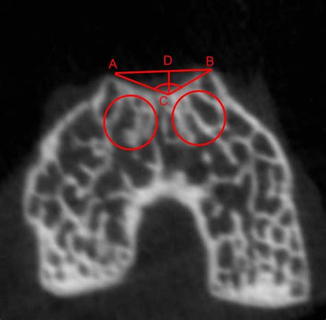 An Axial View Of The Femoral Trochlea Acb Sulcus Angle Cd Trochlear