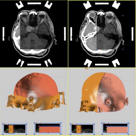 Images Fusion After Registration With A Stereotactic Frame Of Download Scientific Diagram