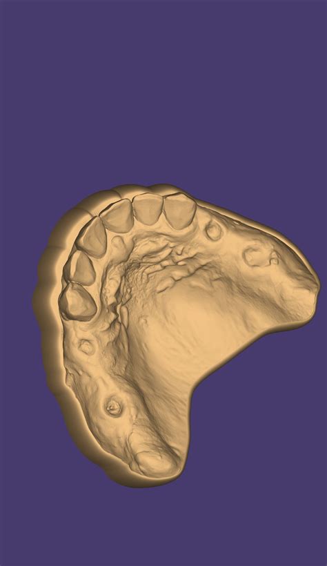 ⚕️ Digital Rpd Model・ Stl File For 3d Printing And Cnc Machining