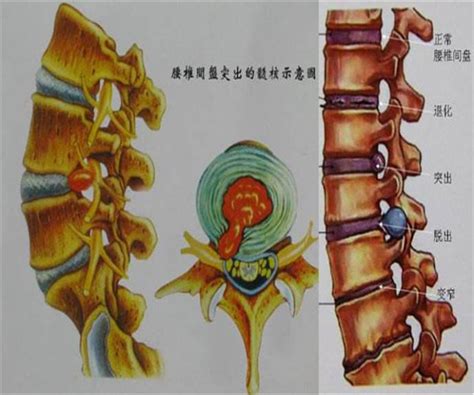 椎间盘突出ct图解有来医生
