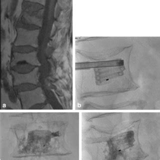 A Year Old Woman With Old Compression Fracture Of T And New Download Scientific Diagram