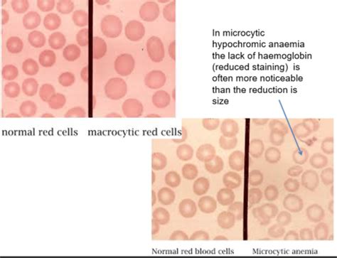 Anemia Flashcards Quizlet