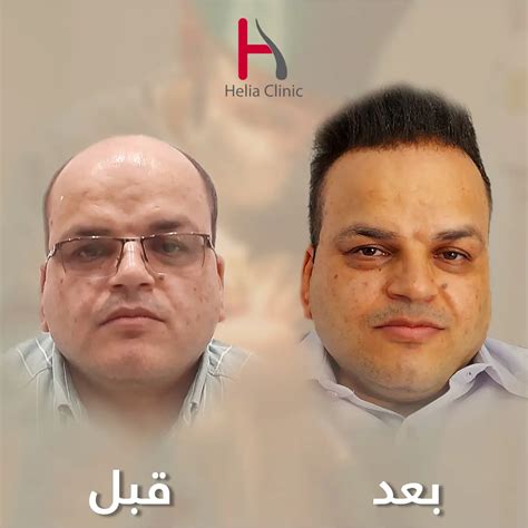 مرکز تخصصی کاشت مو و خدمات زیبایی کلینیک هلیا