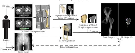 Figure 1 From Bone Mineral Density Estimation From A Plain X Ray Image By Learning Decomposition