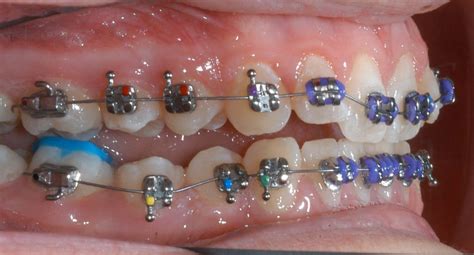 Braces Color Wheel Tag All Perfect Stories