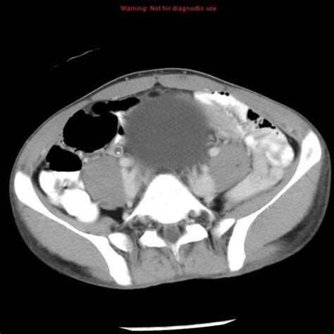Appendicitis Ct Radiopaedia If Left Untreated Appendicitis May Cause Your Appendix To Burst And
