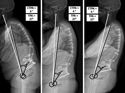 The Consistency Of CTPA And TPA In The Same Patient Despite Varying Download Scientific Diagram