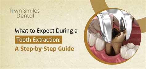 What To Expect During A Tooth Extraction Step By Step
