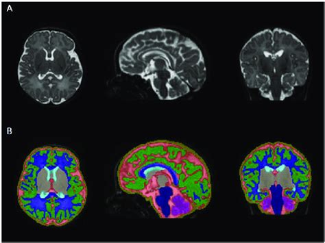 Volumetric Segmentation Of The Neonatal Brain A Reconstructed T2 Download Scientific Diagram