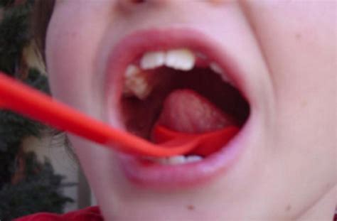 Lifter Tongue Elevation Tool Theraplay