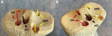 Anterior A And Oblique B Views Of The Proximal Aspect Of An Download Scientific Diagram
