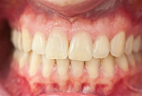 Is Gingivitis Contagious Transmission And Symptoms