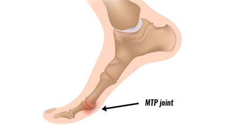 Hallux Rigidus Stiff Big Toe Symptoms Causes And Treatment