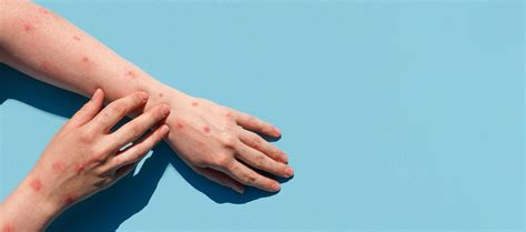 Fda Advises To Use Lesion Swab For Monkeypox Testing Xtalks