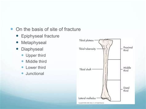 Fracture Classification And Healing Pptx
