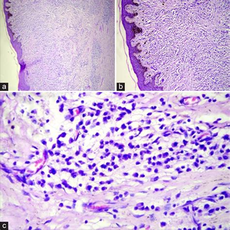 Atypical Presentation Of Plasma Cell Vulvitis Journal Of Skin And