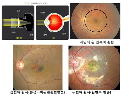 [건강칼럼] 노인 실명 원인 1위 황반변성