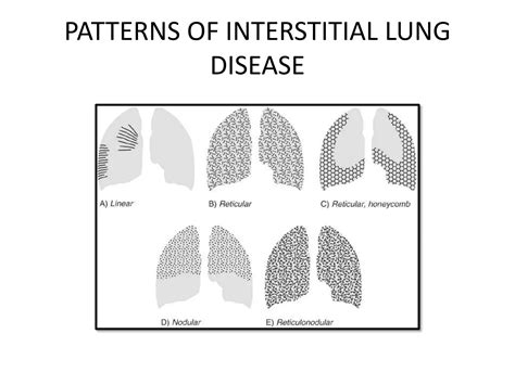 Interstitial Lung Diseases Pptx