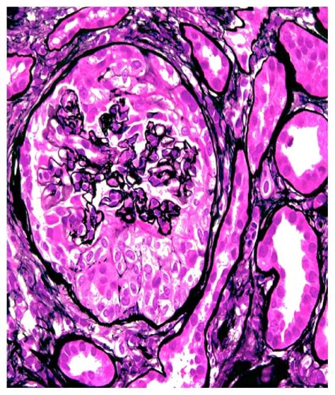 Diffuse Proliferative Glomerulonephritis Wire Looping