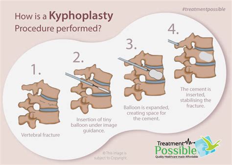 Kyphoplasty Treatment Possible