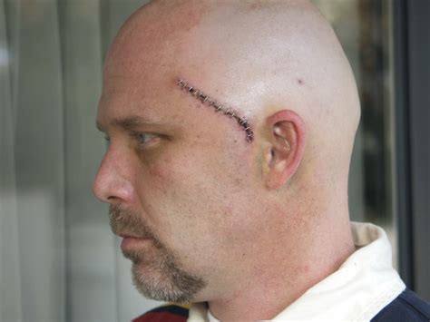 Pictures Of Moyamoya Disease Sufferers And Their Famlies