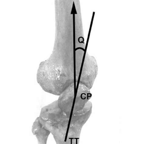 Q Angle Values In The Supine Position In Different Studies Download