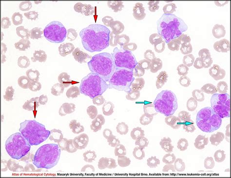 Acute Monoblasticmonocytic Leukaemia Cell Atlas Of Haematological