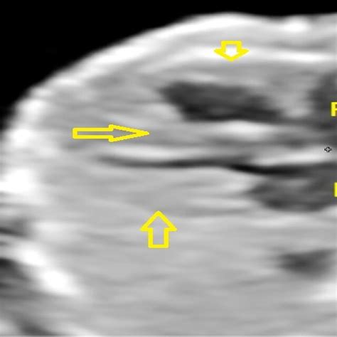 Image Fetal Heart Ultrasound Subcostal View