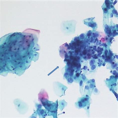 Low Grade Squamous Intraepithelial Lesion Pap ×200 Download Scientific Diagram