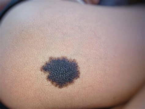 The Mole Guide What Does A Cancerous Mole Look Like Harley Medical Group