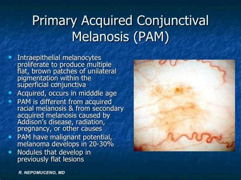 Edandcornea Lecture Fatima